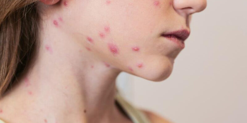 Chickenpox: Symptoms, Causes, Treatment & Prevention | Graphic Era Hospital