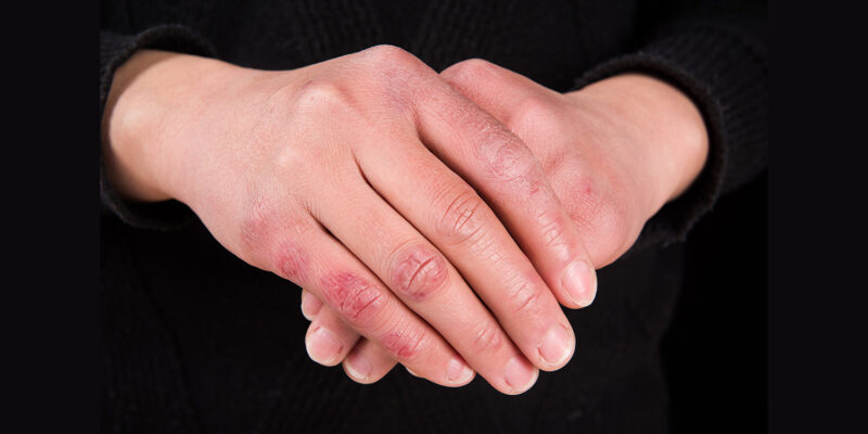 Chilblains: Symptoms, Causes & Treatment for Swollen Fingers in Winter ...